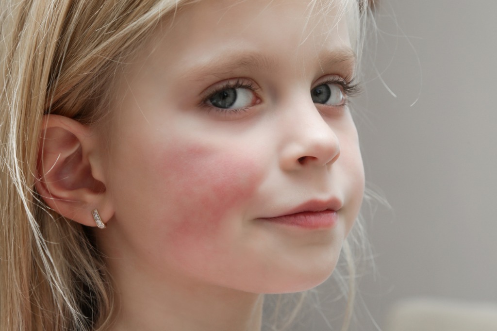 Beyond a Rash: When to Worry About Skin Changes | Connecticut Children's